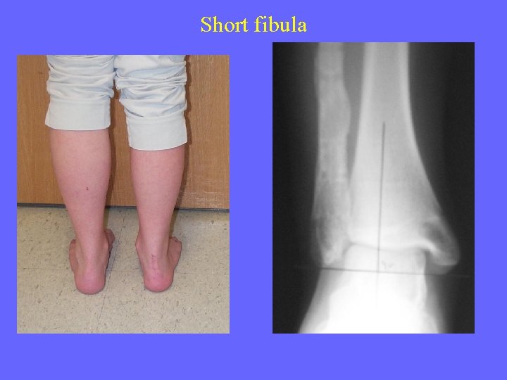 Foot and Ankle Symposium Posttraumatic Reconstruction S Robert