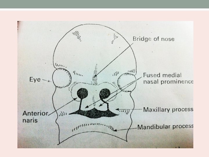 CONGENITAL ANOMALIES OF NOSE AND PNS Embryology Nasal