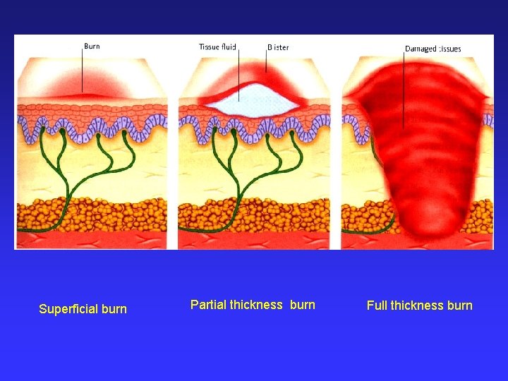 Burns Z Rozkydal Epidermis Dermis blood vessels nerves