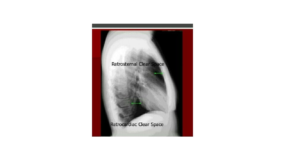 How to read a CXR Dr muna A