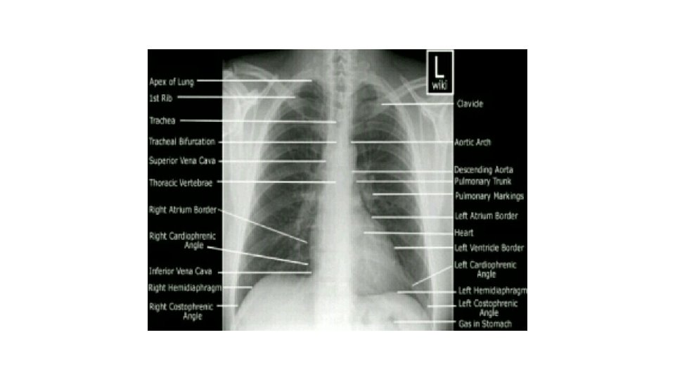 How to read a CXR Dr muna A