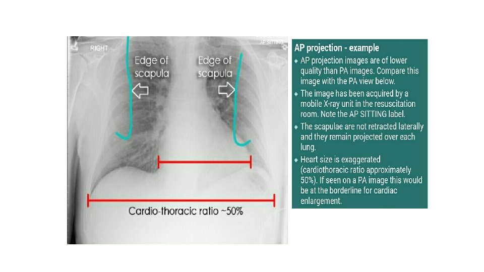 How to read a CXR Dr muna A