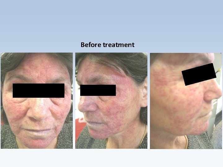 ROSACEA Case report with rosacea papulo pustuloza Bachevski