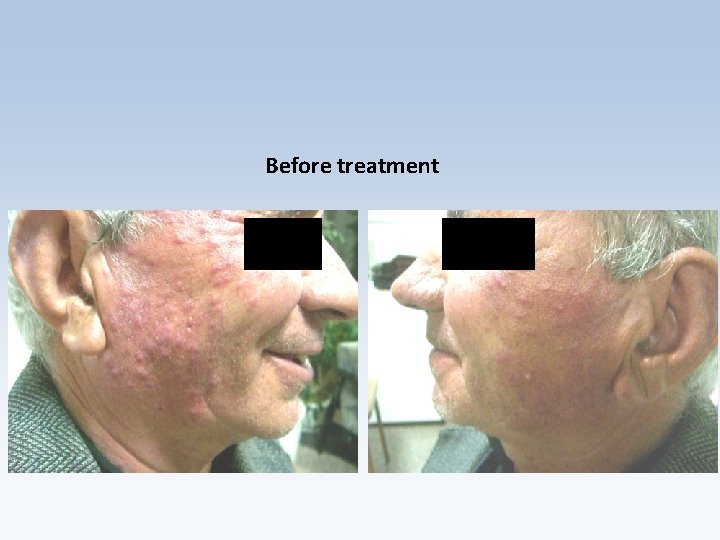ROSACEA Case report with rosacea papulo pustuloza Bachevski