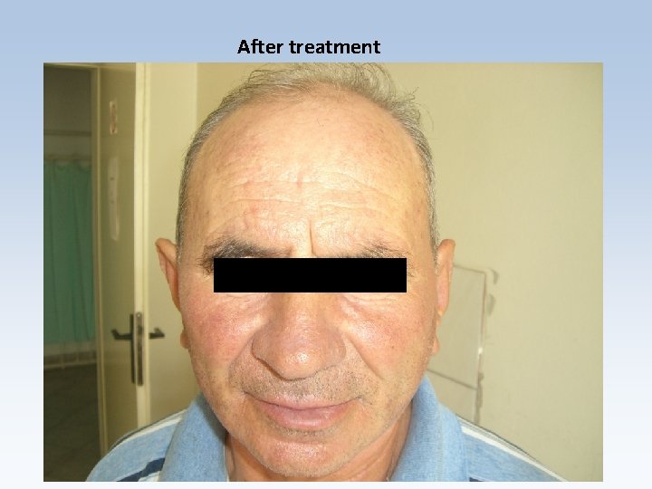 ROSACEA Case report with rosacea papulo pustuloza Bachevski
