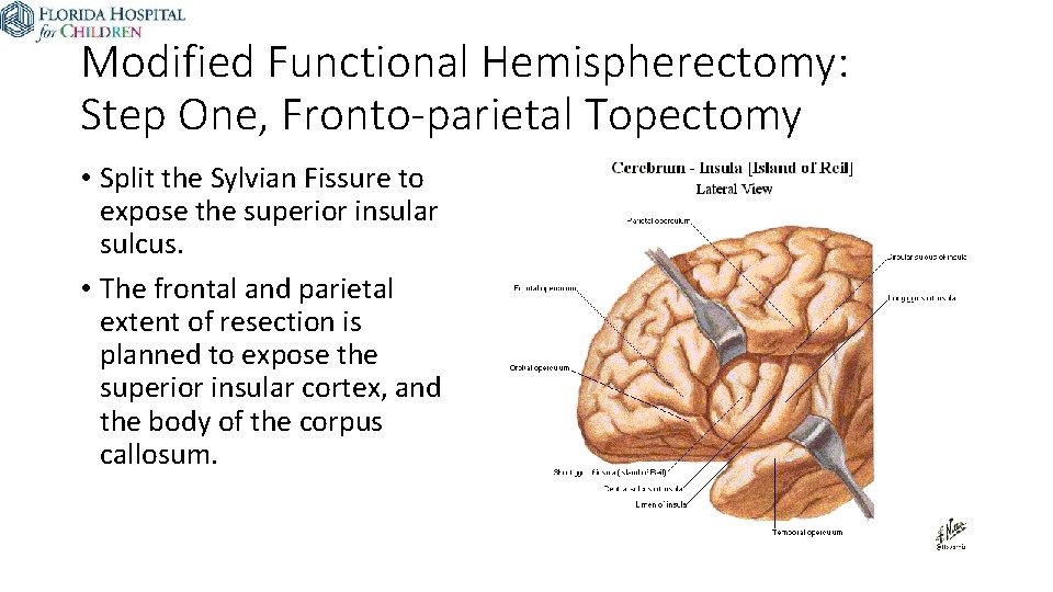 Management of Failed Hemispherectomy James E Baumgartner MD