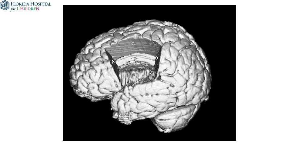 Management of Failed Hemispherectomy James E Baumgartner MD