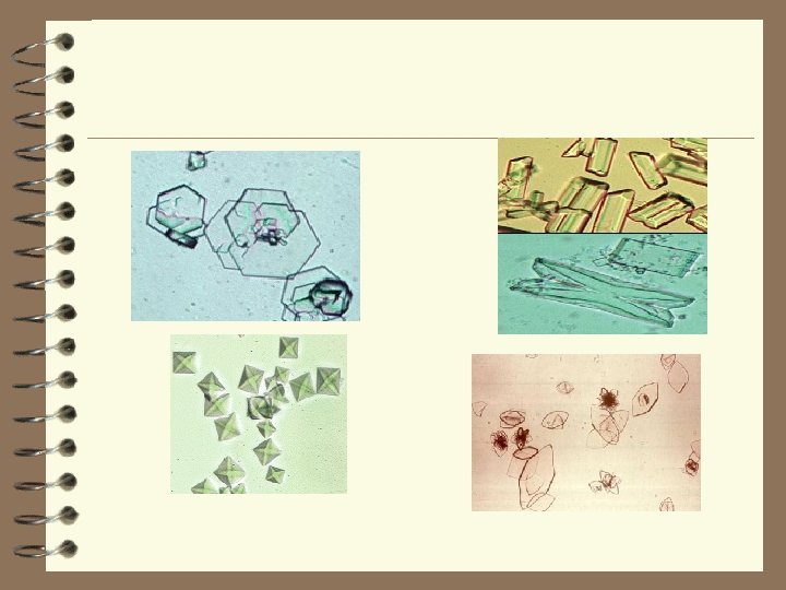 BOARD REVIEW NEPHROLOGY 1 URINALYSIS Proteinuria 1 overflow