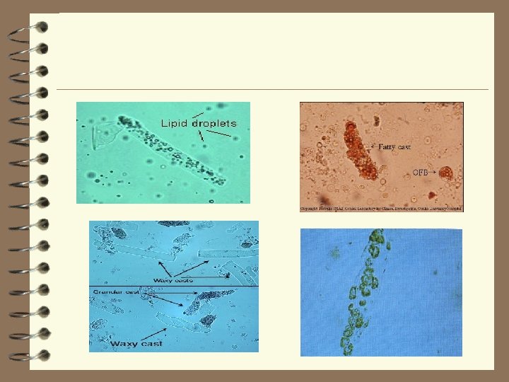 BOARD REVIEW NEPHROLOGY 1 URINALYSIS Proteinuria 1 overflow