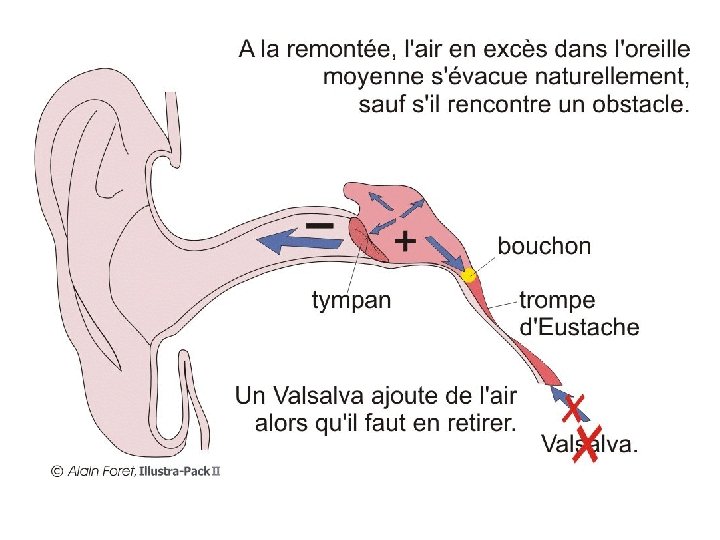 Barotraumatismes Les oreilles La surpression pulmonaire Les sinus