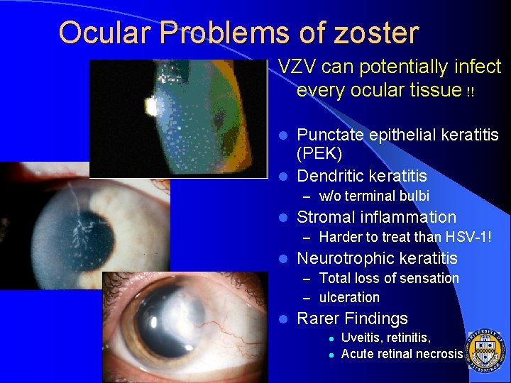 Immune Resolution herpes zosterorigins Replication in Tonsilar epith