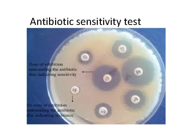 Antibiotic sensitivity test Many bacteria have developed the