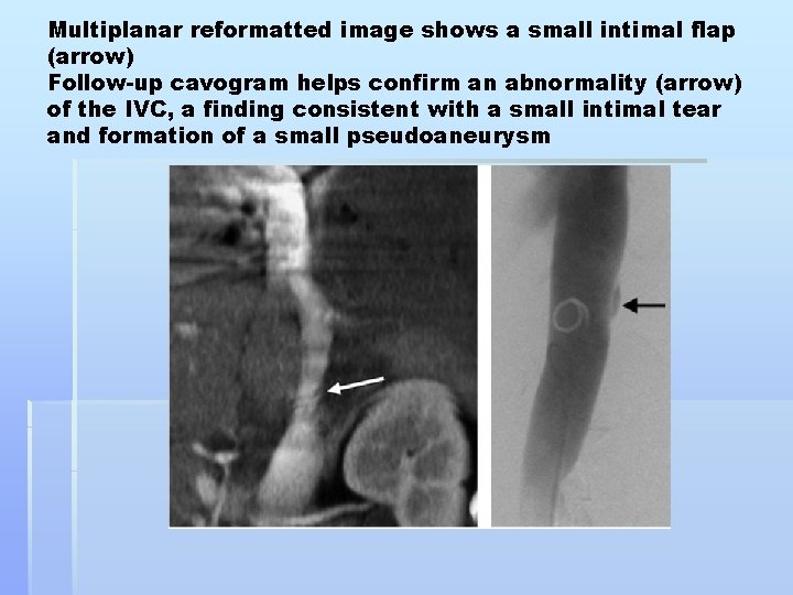 Multidetector CT of Blunt Traumatic Venous Injuries in