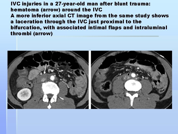 Multidetector CT of Blunt Traumatic Venous Injuries in
