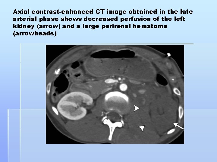 Multidetector CT of Blunt Traumatic Venous Injuries in