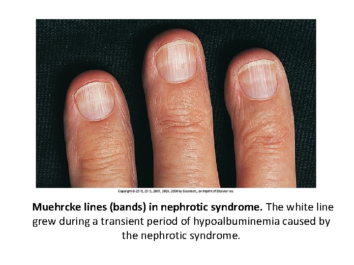 CLINICAL PRESENTATION OF GN DIAGNOSIS History Physical exam