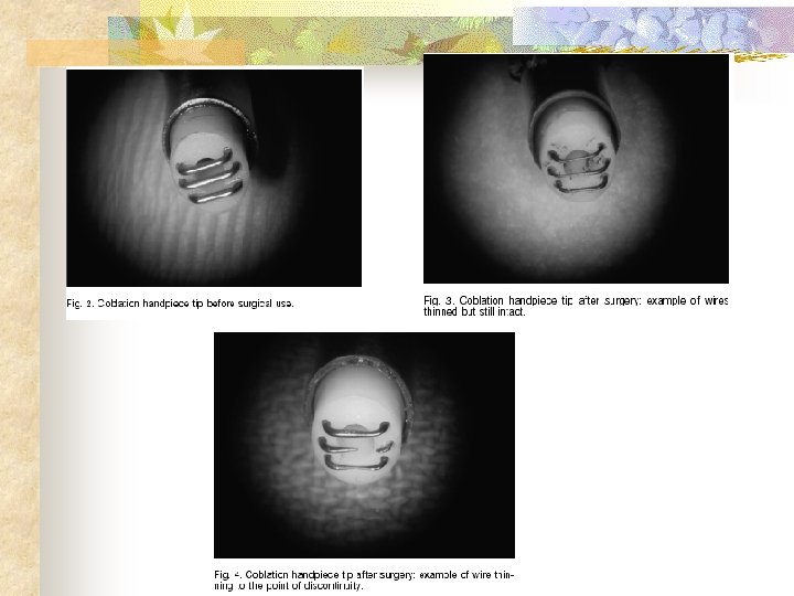 Tonsillectomy Coblation vs Electrocautery Amy Stinson MS IV