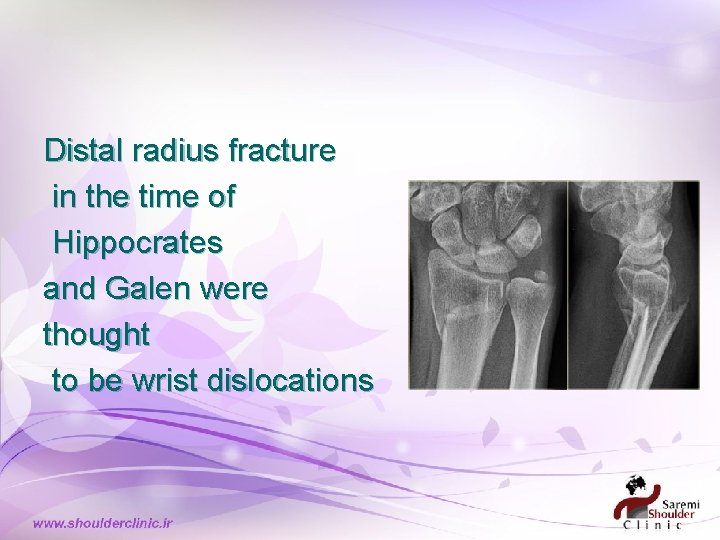Classification of distal radius fx H Saremi MD