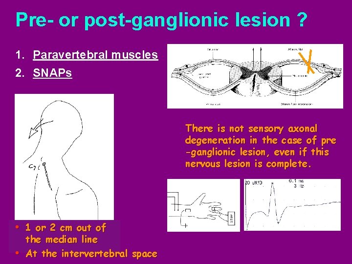 ENMG of Brachial Plexus F Wang To exclude