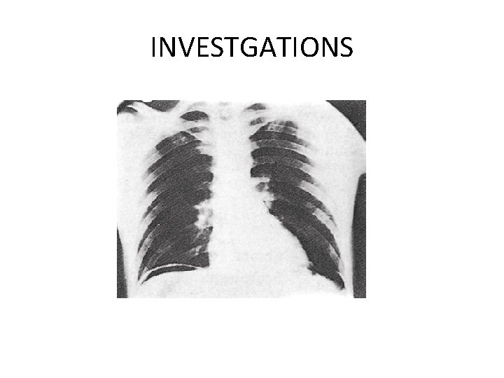 VAGOTOMY Types of vagotomy A Highly selective vagotomy