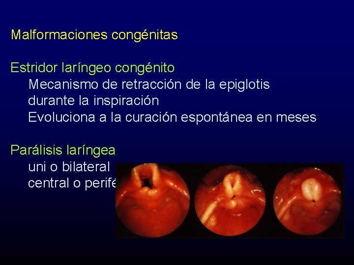 Laringe Patologa Causas frecuentes de patologa larngea Malformaciones