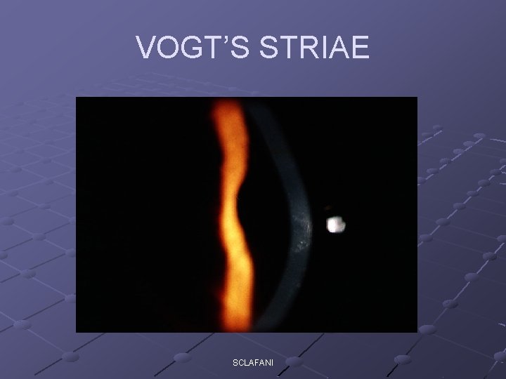 Update on Keratoconus Diagnosis and Treatment Mahdavi MD