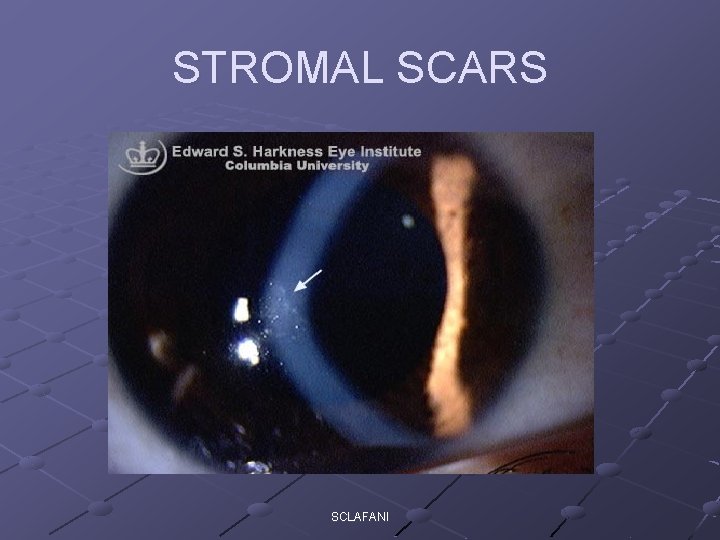 Update on Keratoconus Diagnosis and Treatment Mahdavi MD