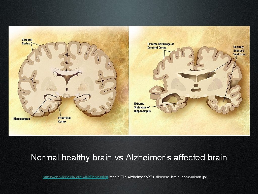 Dementia and Dentistry An Overview by Natalie Wilson