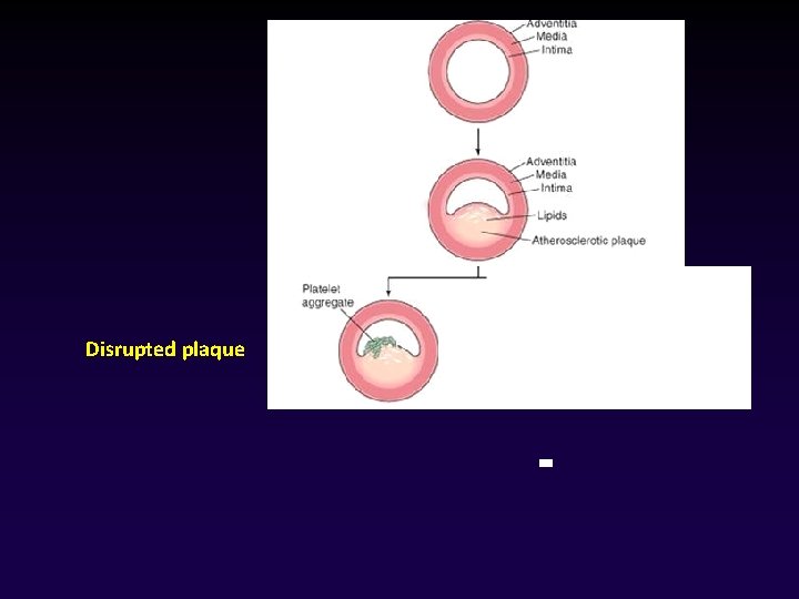 Heart Failure Ischemic Heart Disease Aneurysm and Dissection