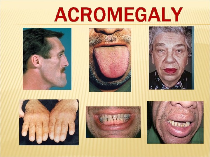 Management of patients with Acromegaly H Delshad M