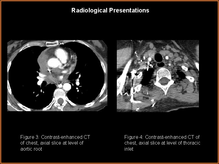 Radiological Category Thoracic Chest Principal Modality 1 CT