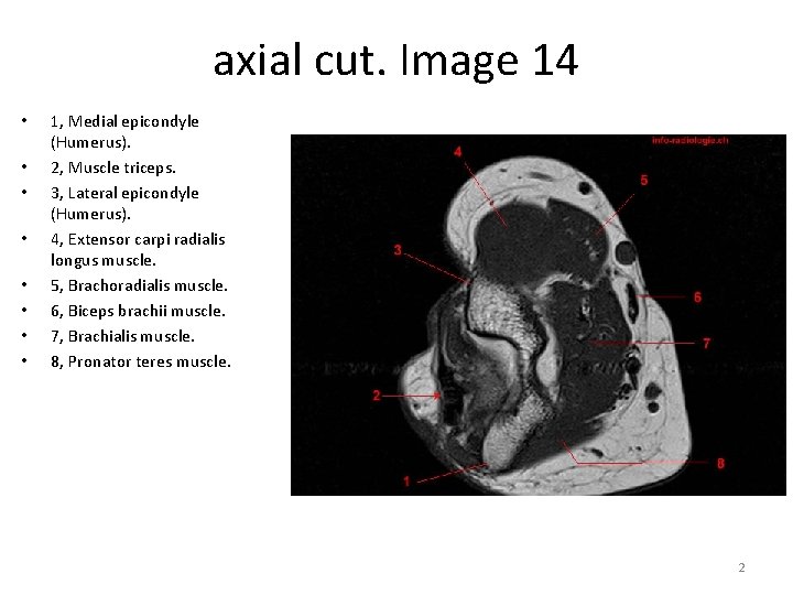 axial cut Image 16 1 Medial epicondyle Humerus