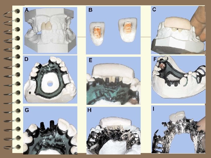 Fabricating Removable Partial Denture Bases 1 Factors Affecting