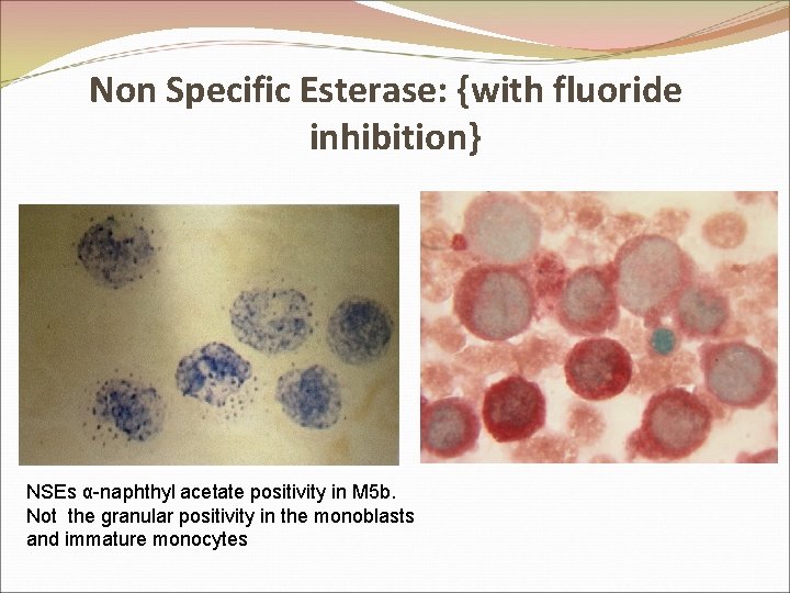 Special Stain Cytochemical Reactions in Acute Leukemia Cytochemical