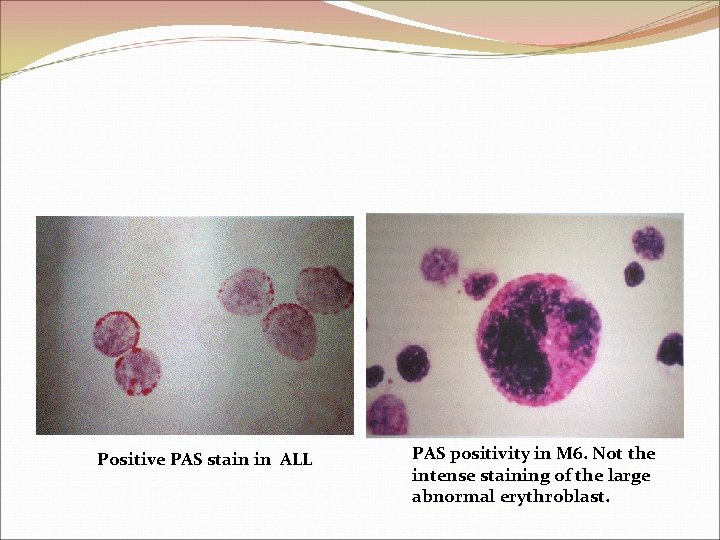 Special Stain Cytochemical Reactions in Acute Leukemia Cytochemical