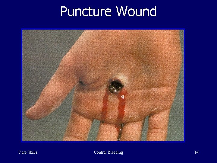 Control Bleeding and Hypovolemic Shock Core Skills Control