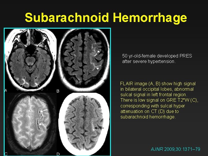 e SE number 49 Posterior Reversible Encephalopathy Syndrome
