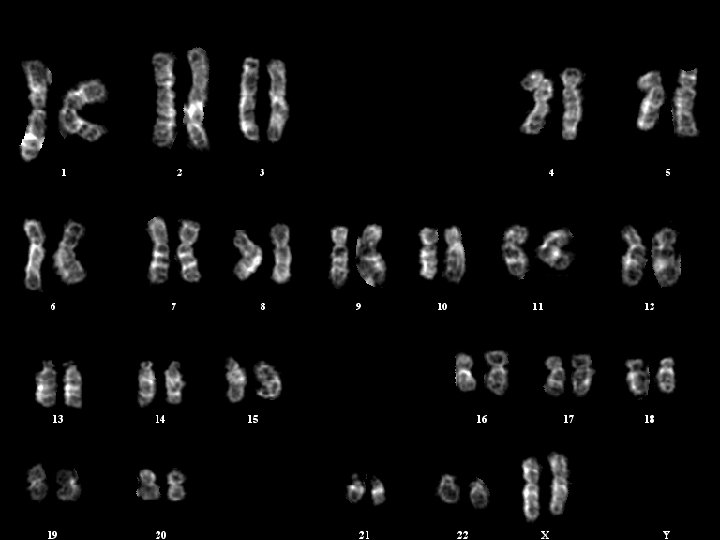 Chromosomal Mutations their effects Karyotype A picture of