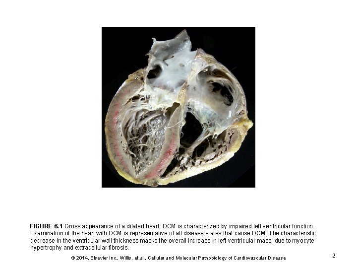 Chapter 6 Pathophysiology of Cardiomyopathies 2014 Elsevier Inc