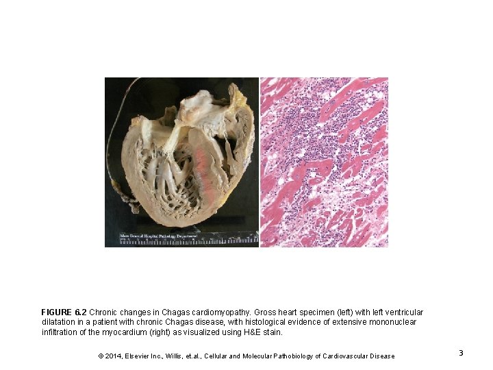 Chapter 6 Pathophysiology of Cardiomyopathies 2014 Elsevier Inc
