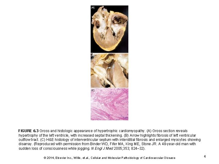 Chapter 6 Pathophysiology of Cardiomyopathies 2014 Elsevier Inc