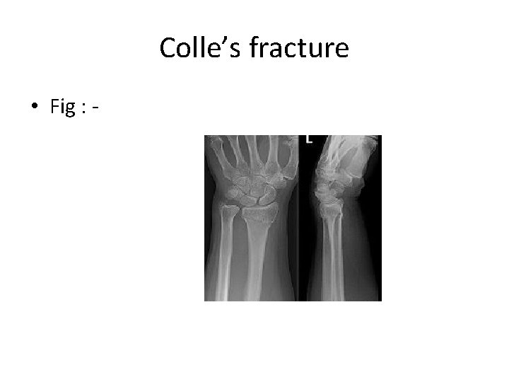 Injuries of the forearm By Dr sanjeev Normal