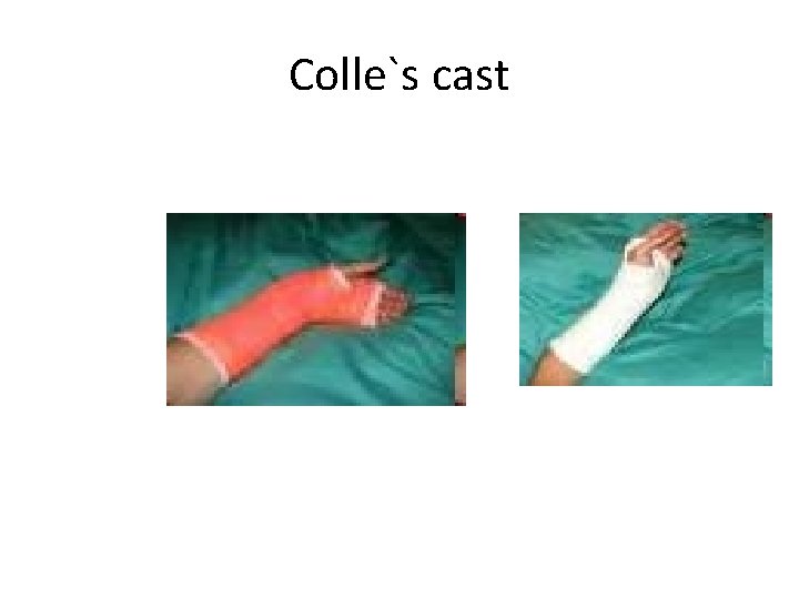 Injuries of the forearm By Dr sanjeev Normal