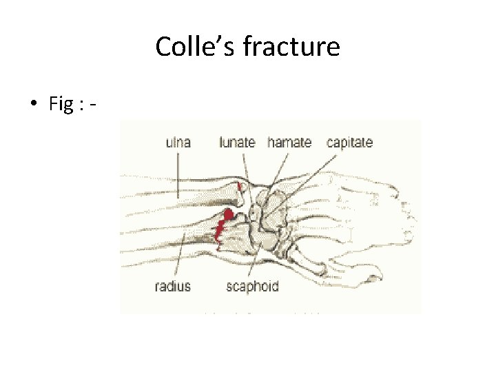 Injuries of the forearm By Dr sanjeev Normal