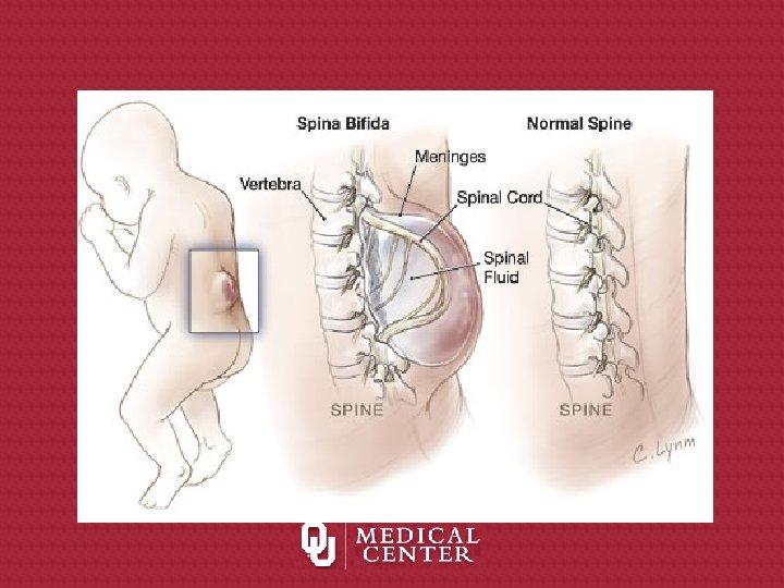 Case Presentation Myelomeningocele Stephen Confer MD Ben O