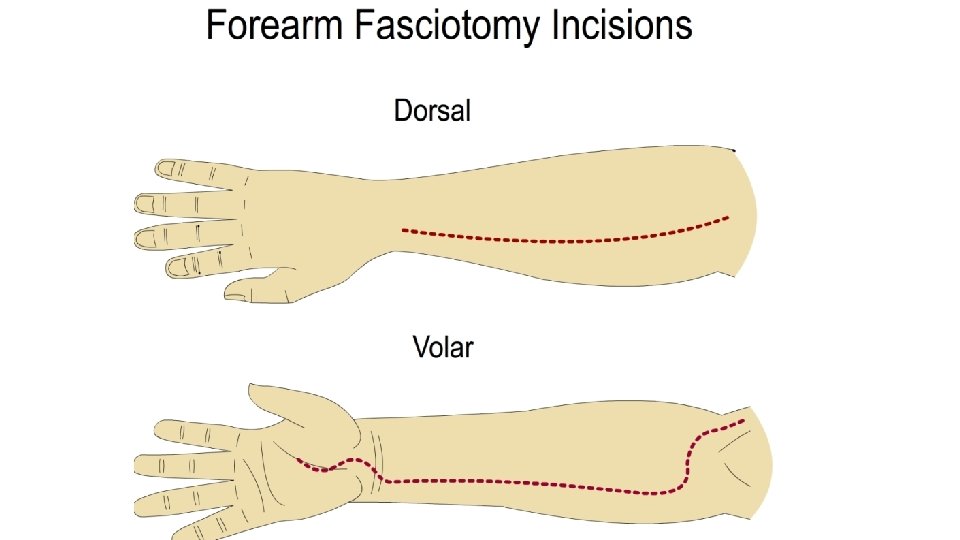 Acute compartment syndrome Acute joint dislocation Abdulaziz Alomar