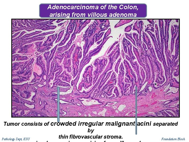 PRACTICAL 6 NEOPLASIA MALIGNANT TUMORS Pathology Dept KSU