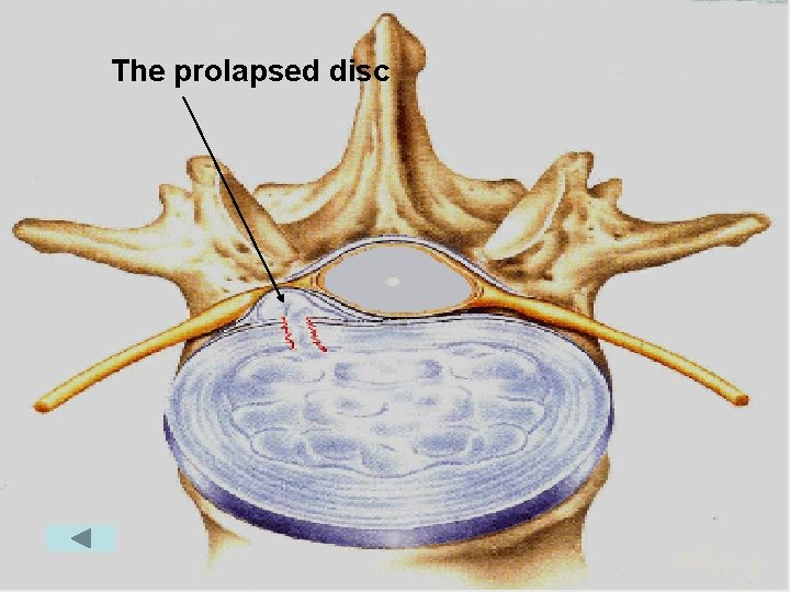 Acupuncture for the syndrome of prolapsed lumbar Intervertebral