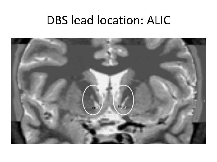 Neuromodulation what the future brings Alon Y Mogilner