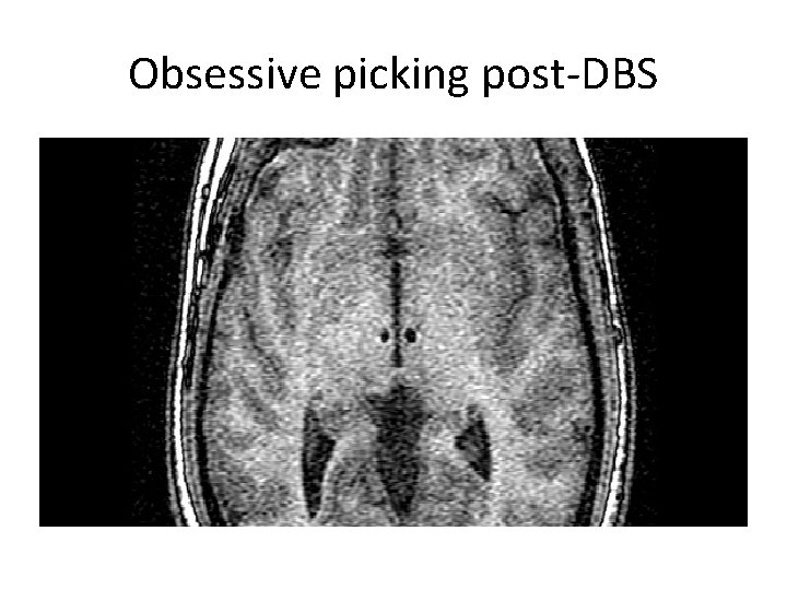 Neuromodulation what the future brings Alon Y Mogilner